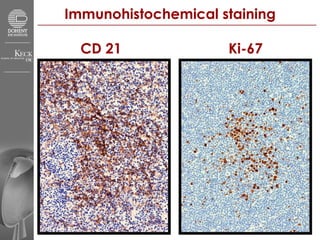 Conjunctival MALT Lymphoma | PPT