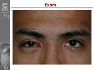 Conjunctival MALT Lymphoma | PPT