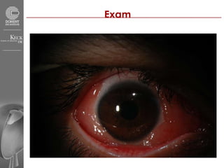 Conjunctival MALT Lymphoma | PPT