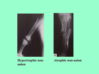 Malunion_Delayed_Union_and_Nonunion_fractures.ppt | Death, Injury, or ...