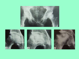 Malunion_Delayed_Union_and_Nonunion_fractures_4.ppt