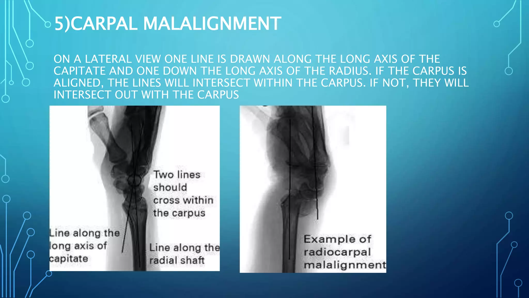 Malunited Distal End Radius Fractures | PPTX
