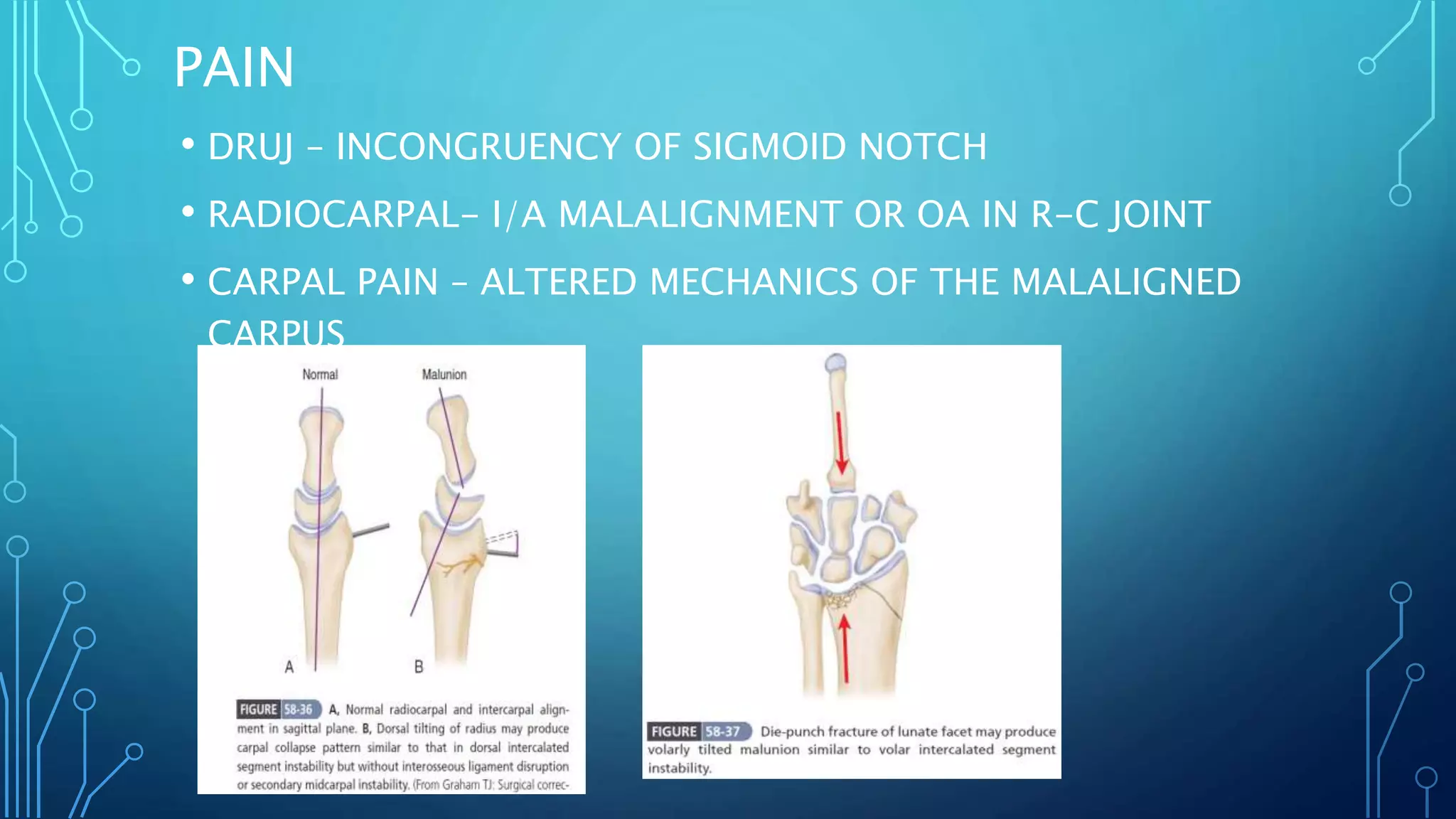 Malunited Distal End Radius Fractures | PPTX