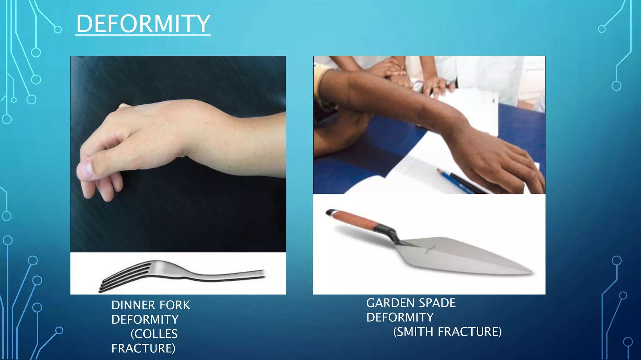 Malunited Distal End Radius Fractures | PPTX