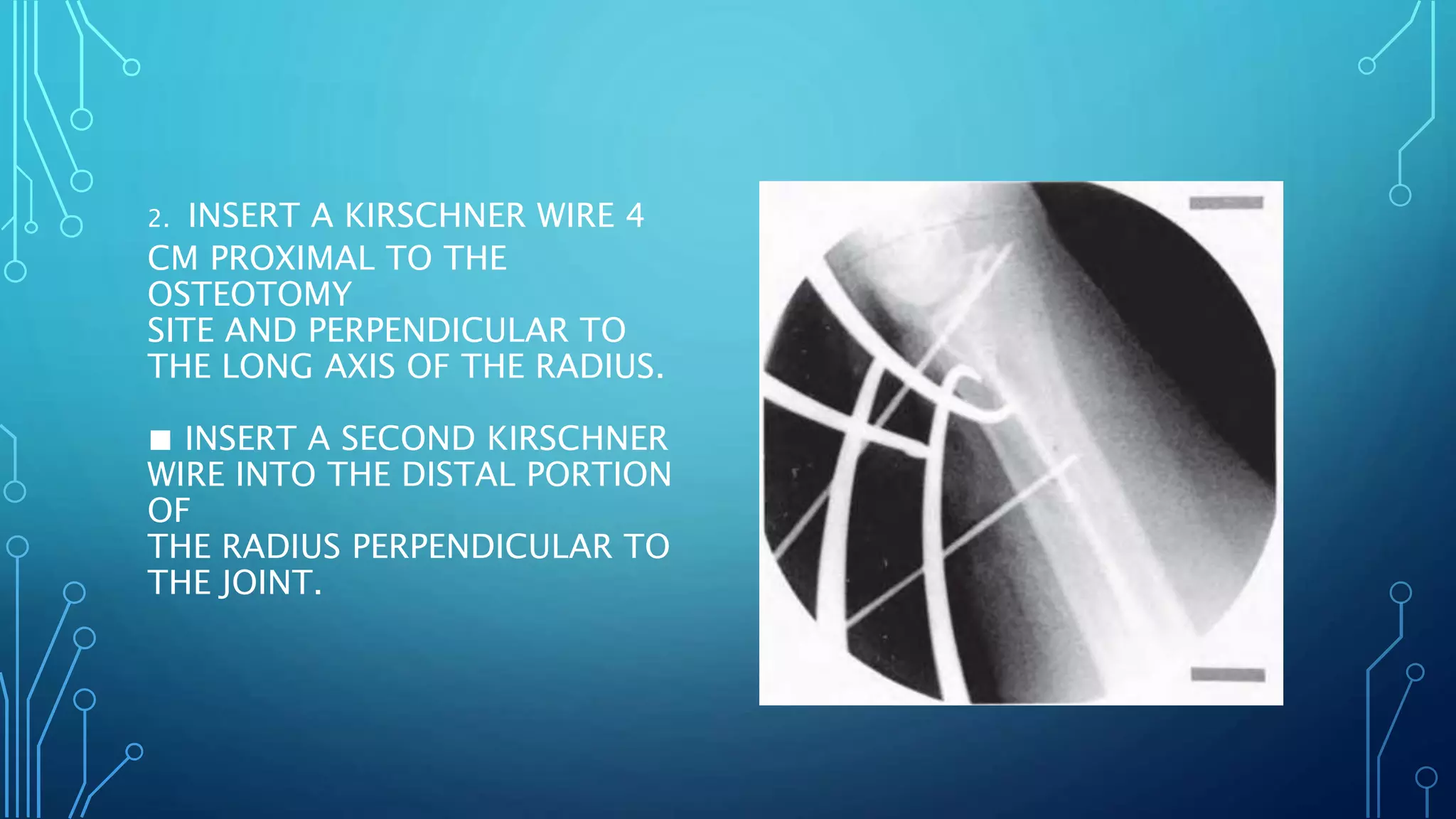 Malunited Distal End Radius Fractures | PPTX