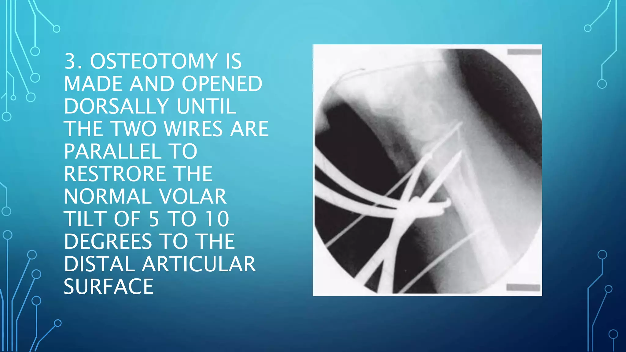 Malunited Distal End Radius Fractures | PPTX