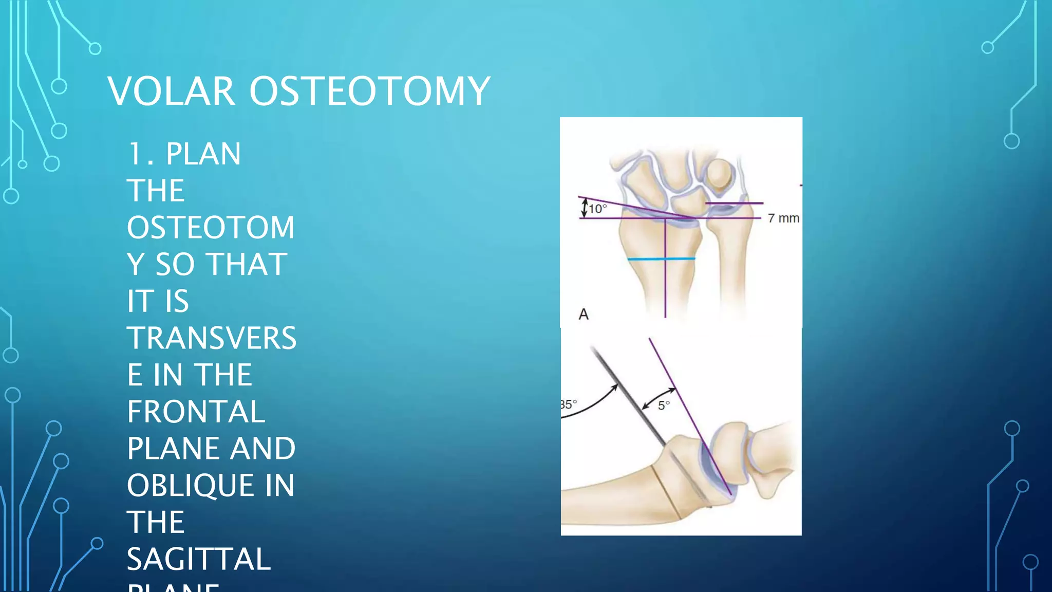 Malunited Distal End Radius Fractures | PPTX