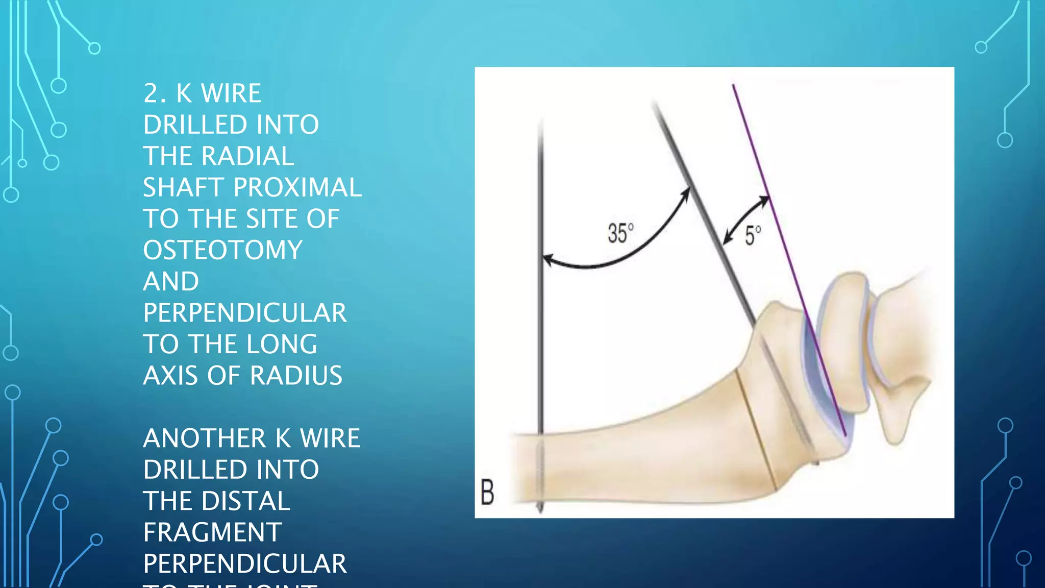 Malunited Distal End Radius Fractures | PPTX