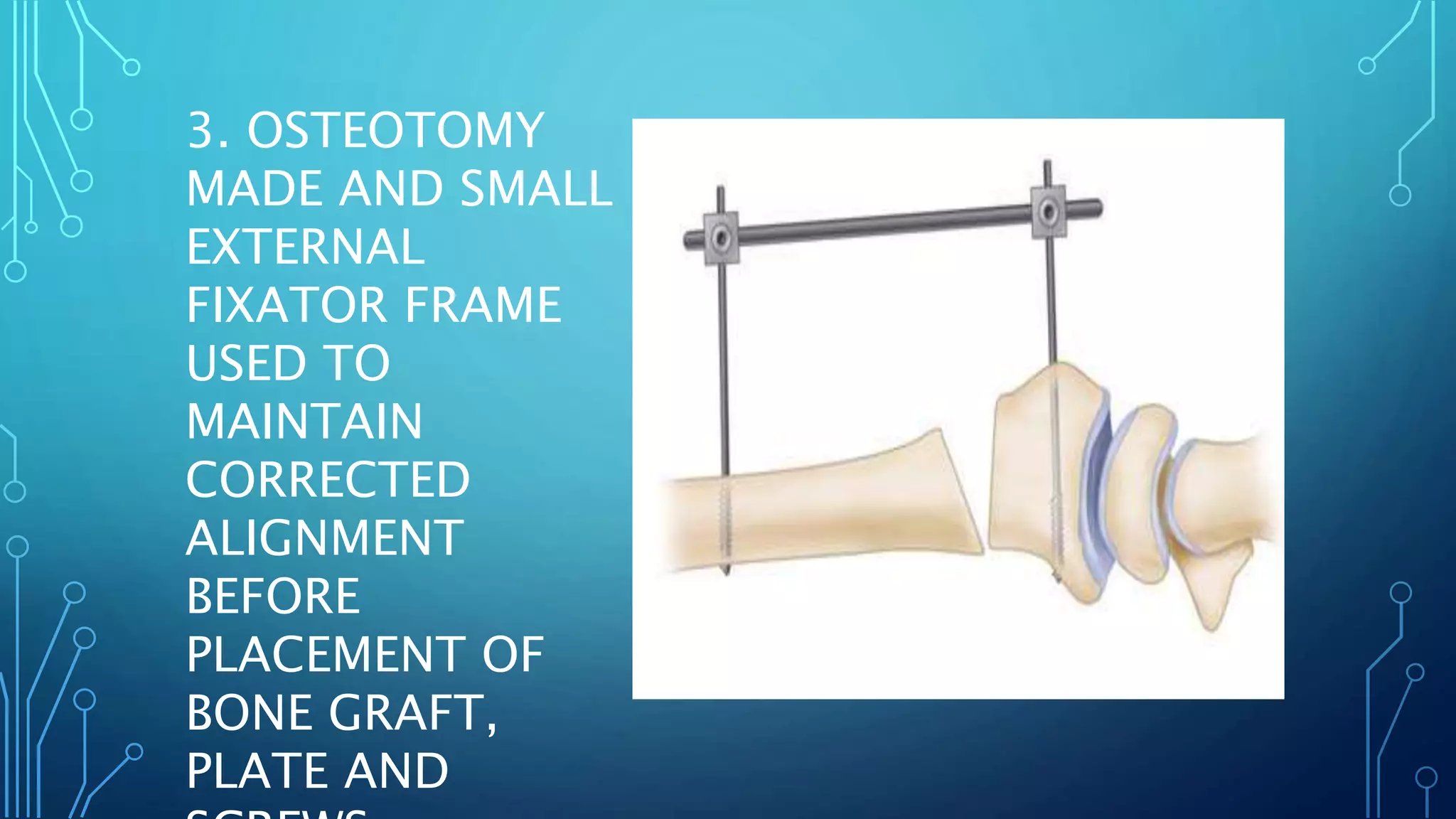Malunited Distal End Radius Fractures | PPTX