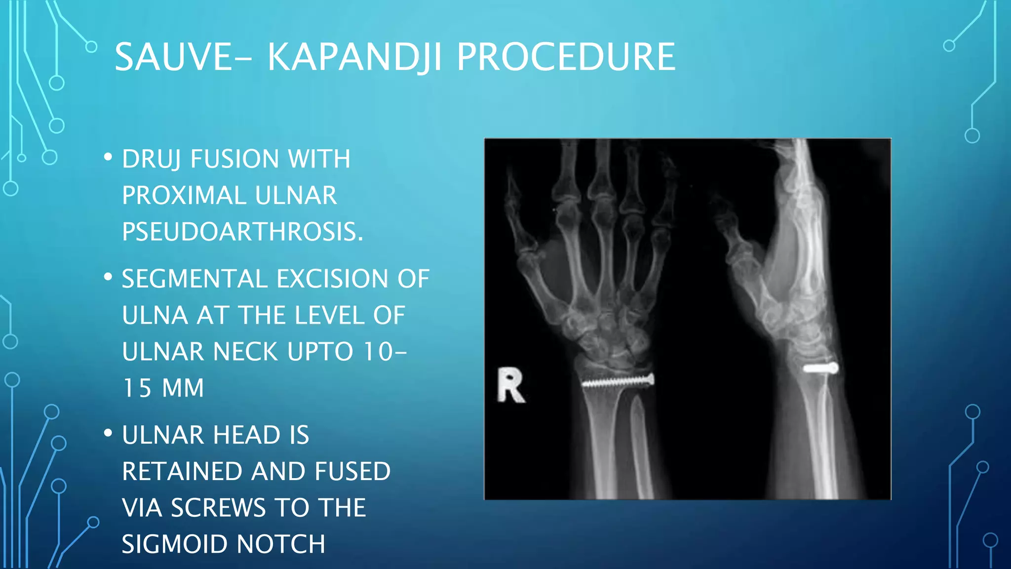 Malunited Distal End Radius Fractures | PPTX