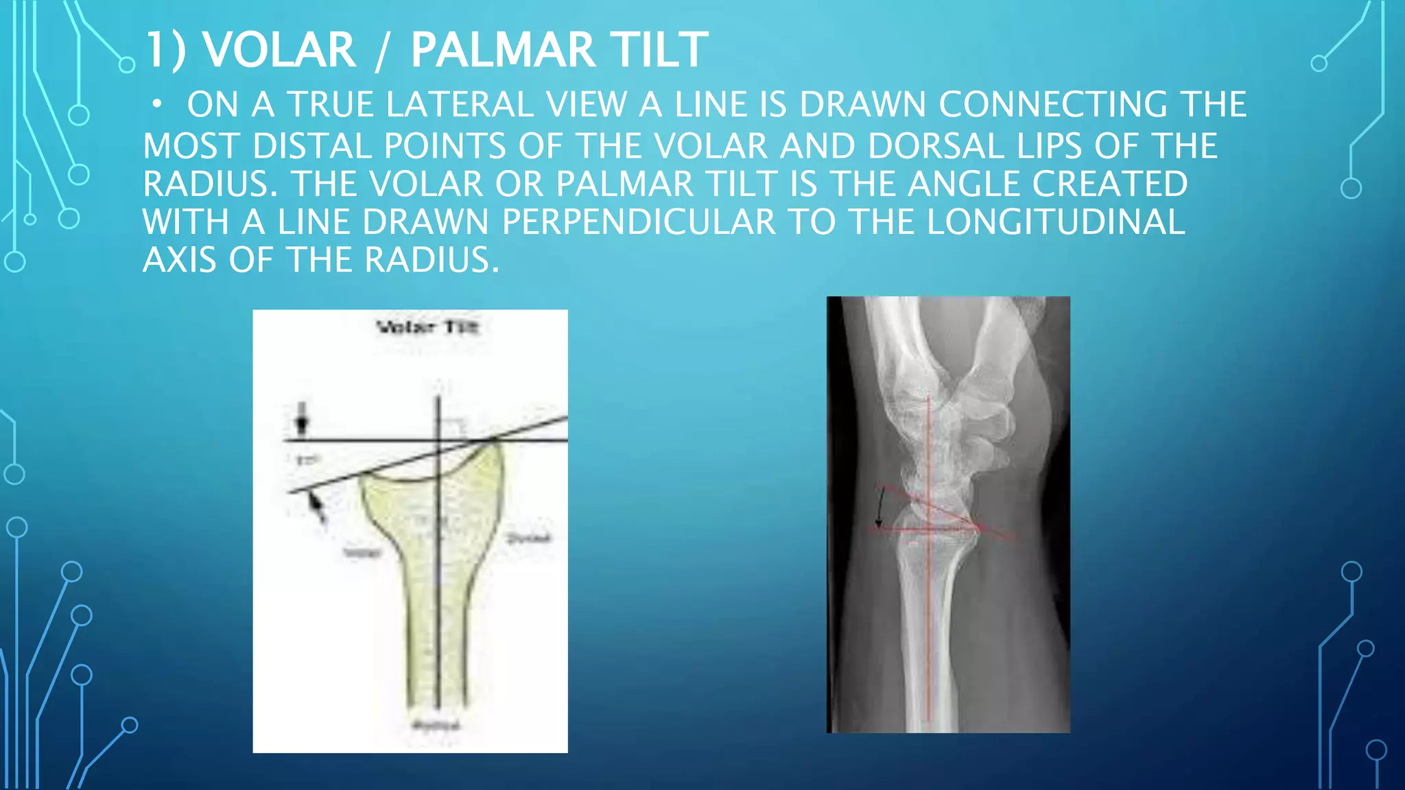 Malunited Distal End Radius Fractures | PPTX