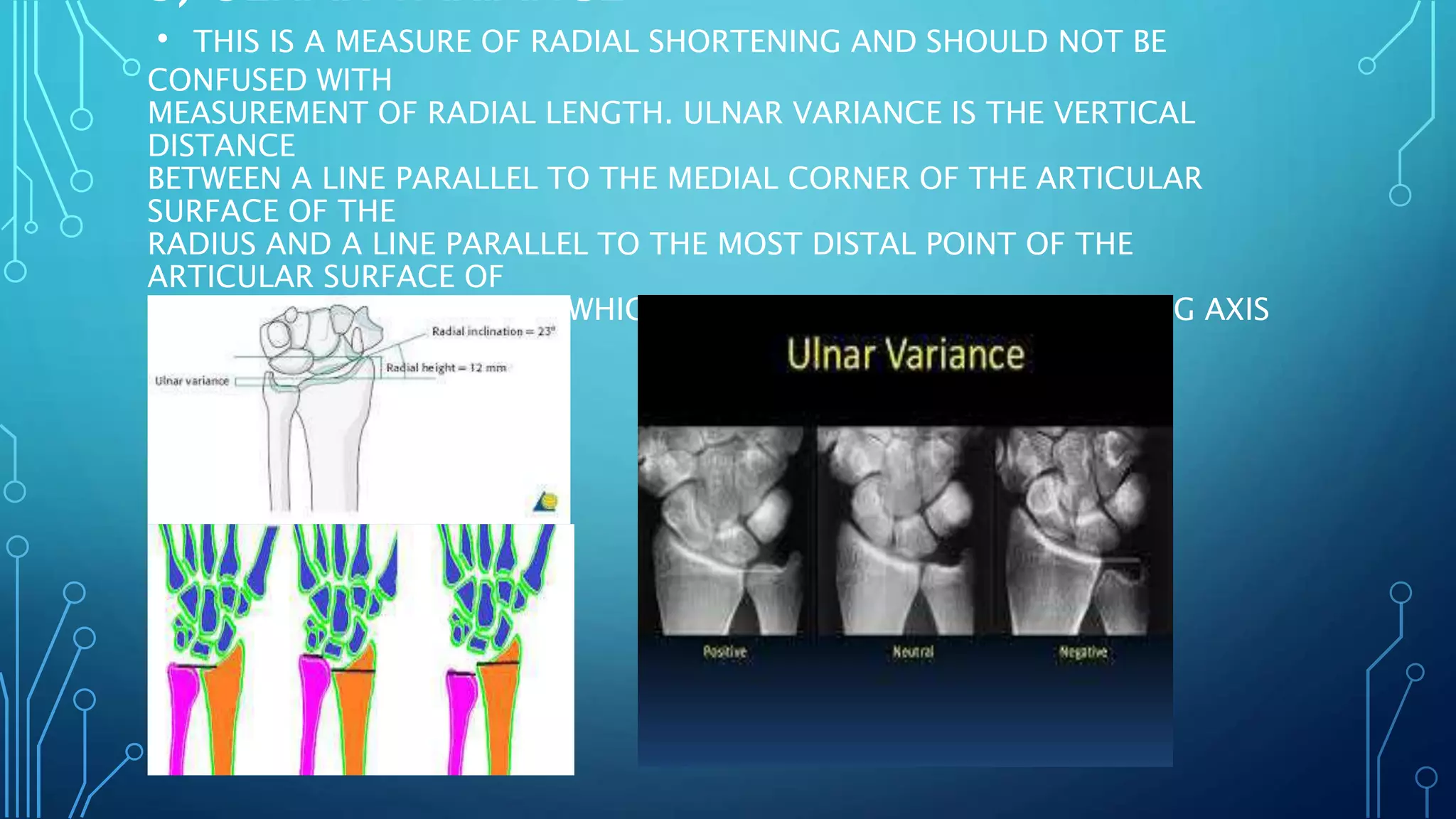 Malunited Distal End Radius Fractures | PPTX