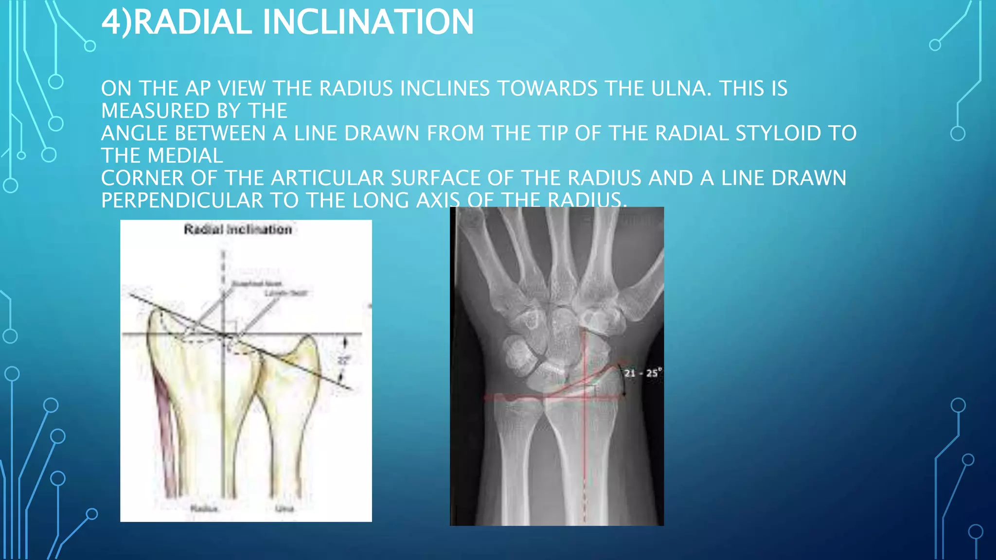 Malunited Distal End Radius Fractures | PPTX