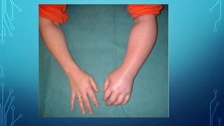 Malunited Distal End Radius Fractures | PPTX