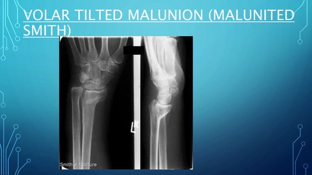 Malunited Distal End Radius Fractures | PPTX