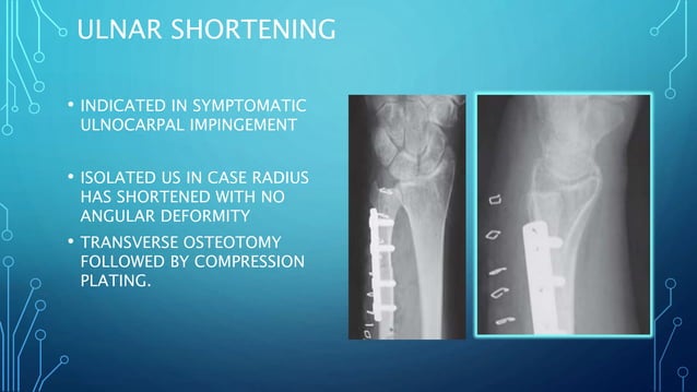 Malunited Distal End Radius Fractures | PPTX