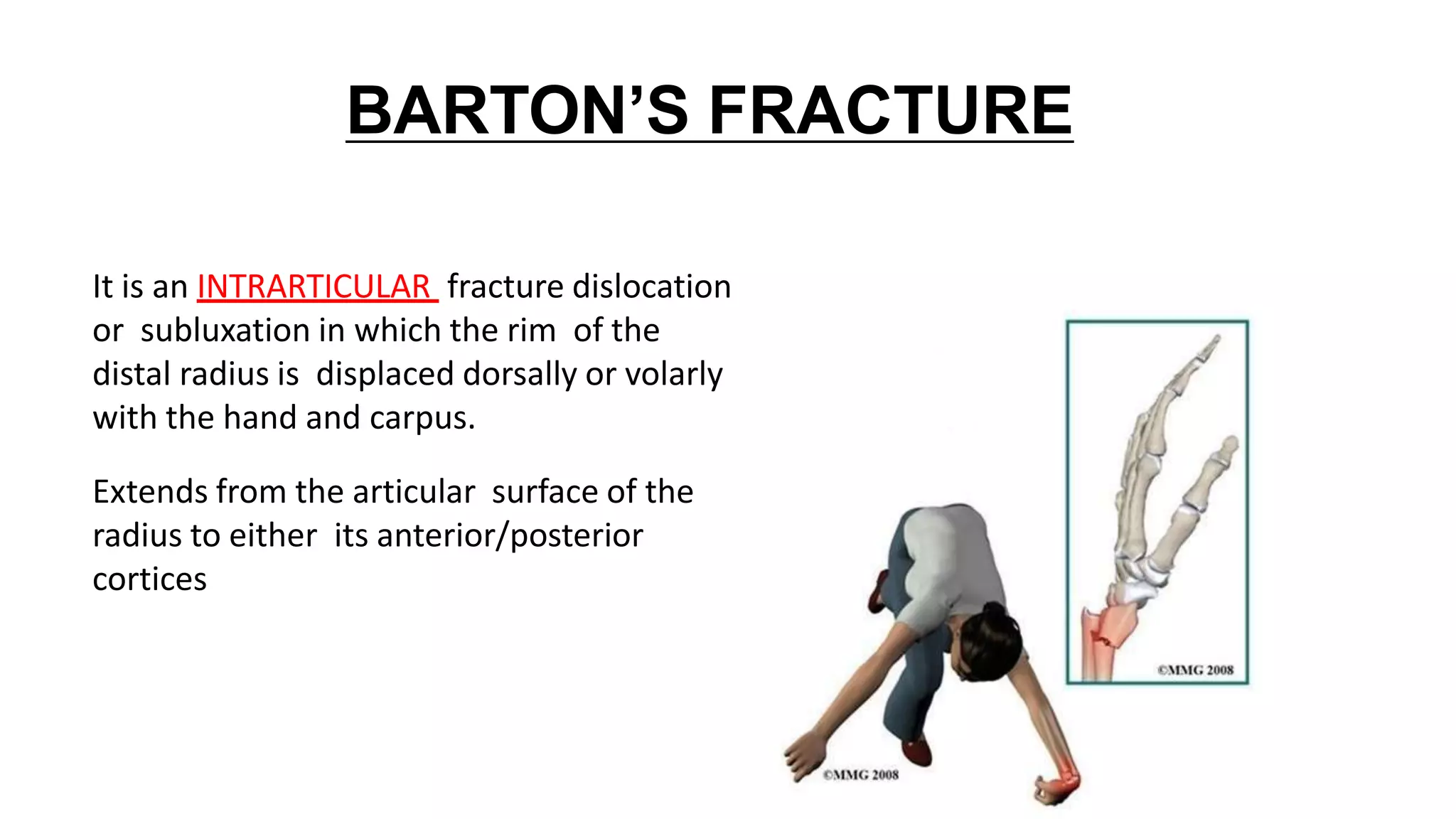 Malunited distal radius fracture | PPTX