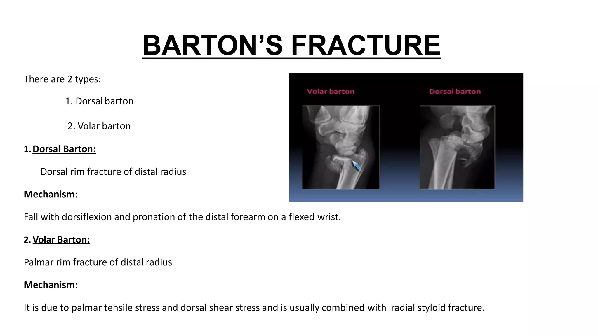 Malunited distal radius fracture | PPTX