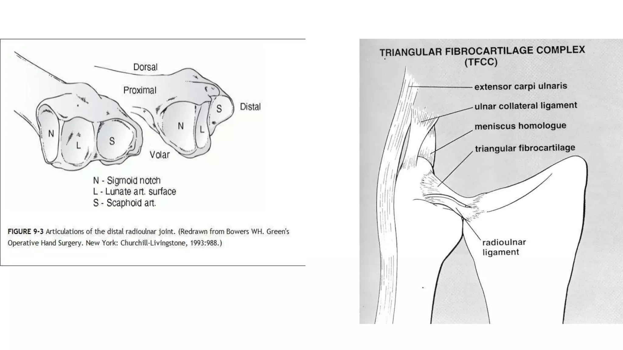 Malunited distal radius fracture | PPTX