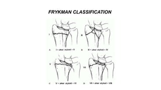 Malunited distal radius fracture | PPTX
