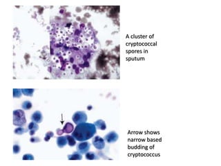 Cytologic assessment of bronchopulmonary lesions | PPTX