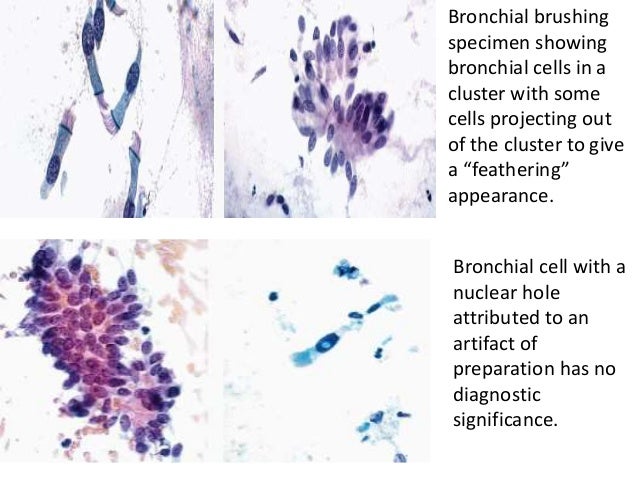 Cytologic assessment of bronchopulmonary lesions