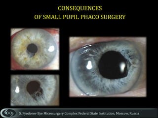 Surgical strategies for small pupils - Malyugin Ring | PPTX
