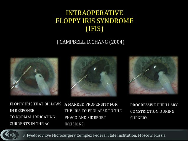 Surgical strategies for small pupils - Malyugin Ring