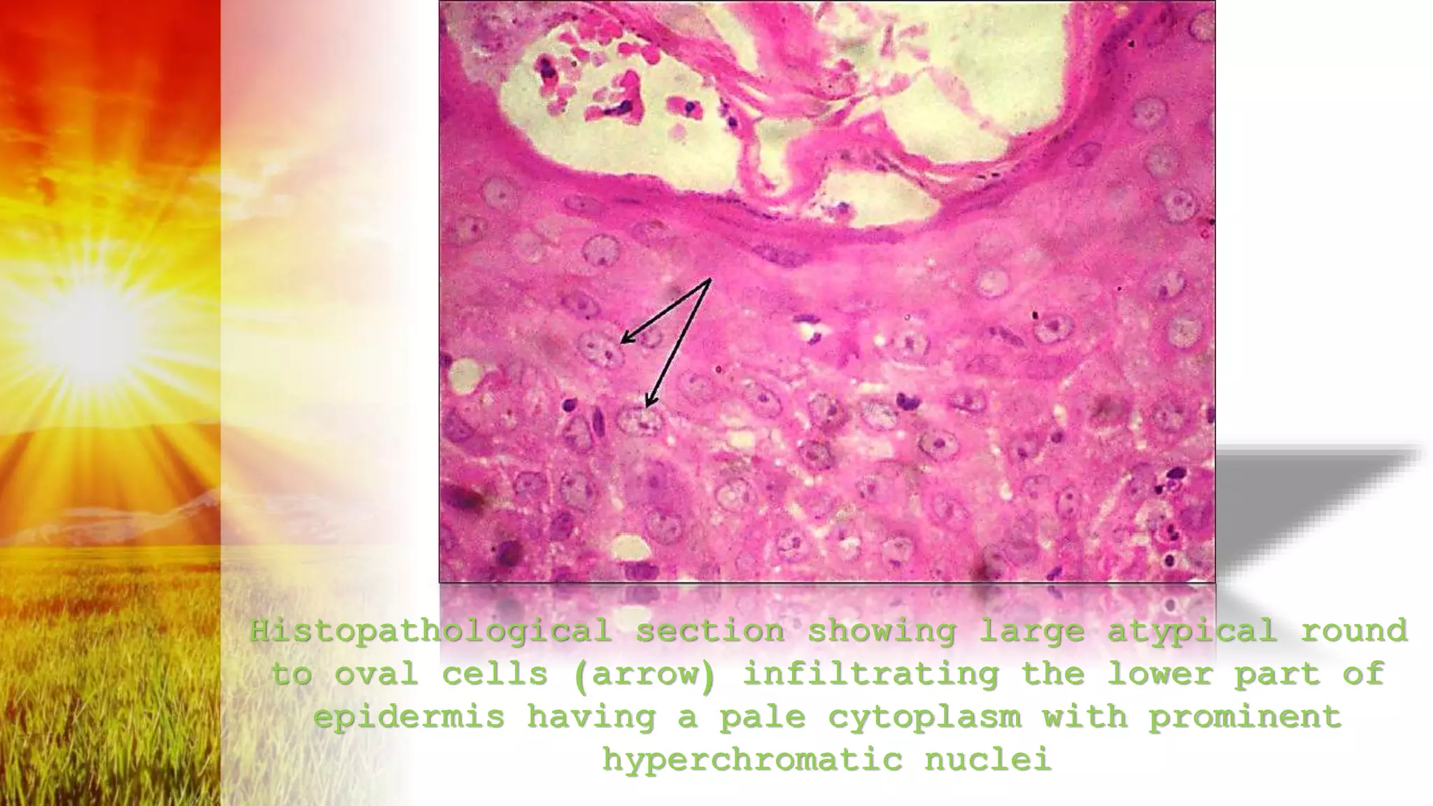 Mammary Paget Disease (MPD) & Extramammary Paget disease (EMPD) | PPTX