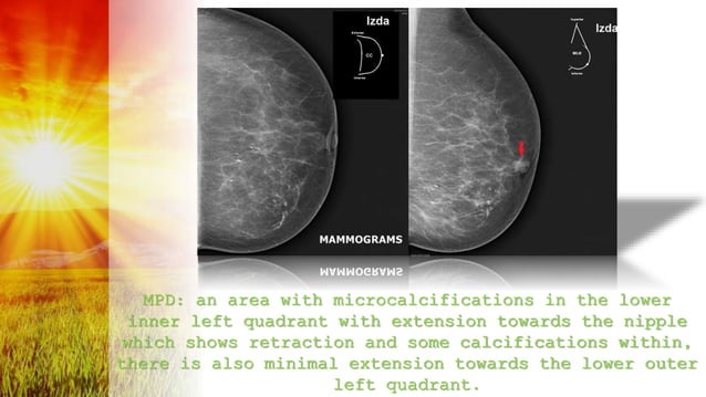 Mammary Paget Disease (MPD) & Extramammary Paget disease (EMPD) | PPTX