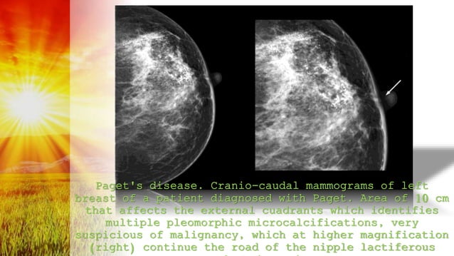 Mammary Paget Disease (MPD) & Extramammary Paget disease (EMPD) | PPTX