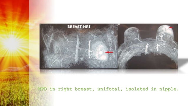 Mammary Paget Disease (MPD) & Extramammary Paget disease (EMPD) | PPTX