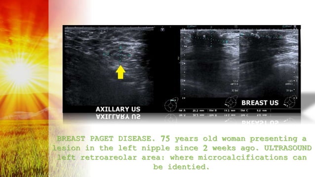 Mammary Paget Disease (MPD) & Extramammary Paget disease (EMPD) | PPTX