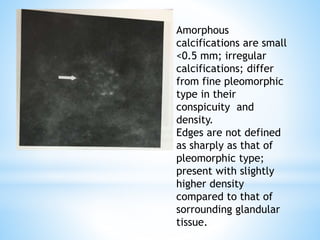 Role of mammography and MRI in Breast disorders | PPTX