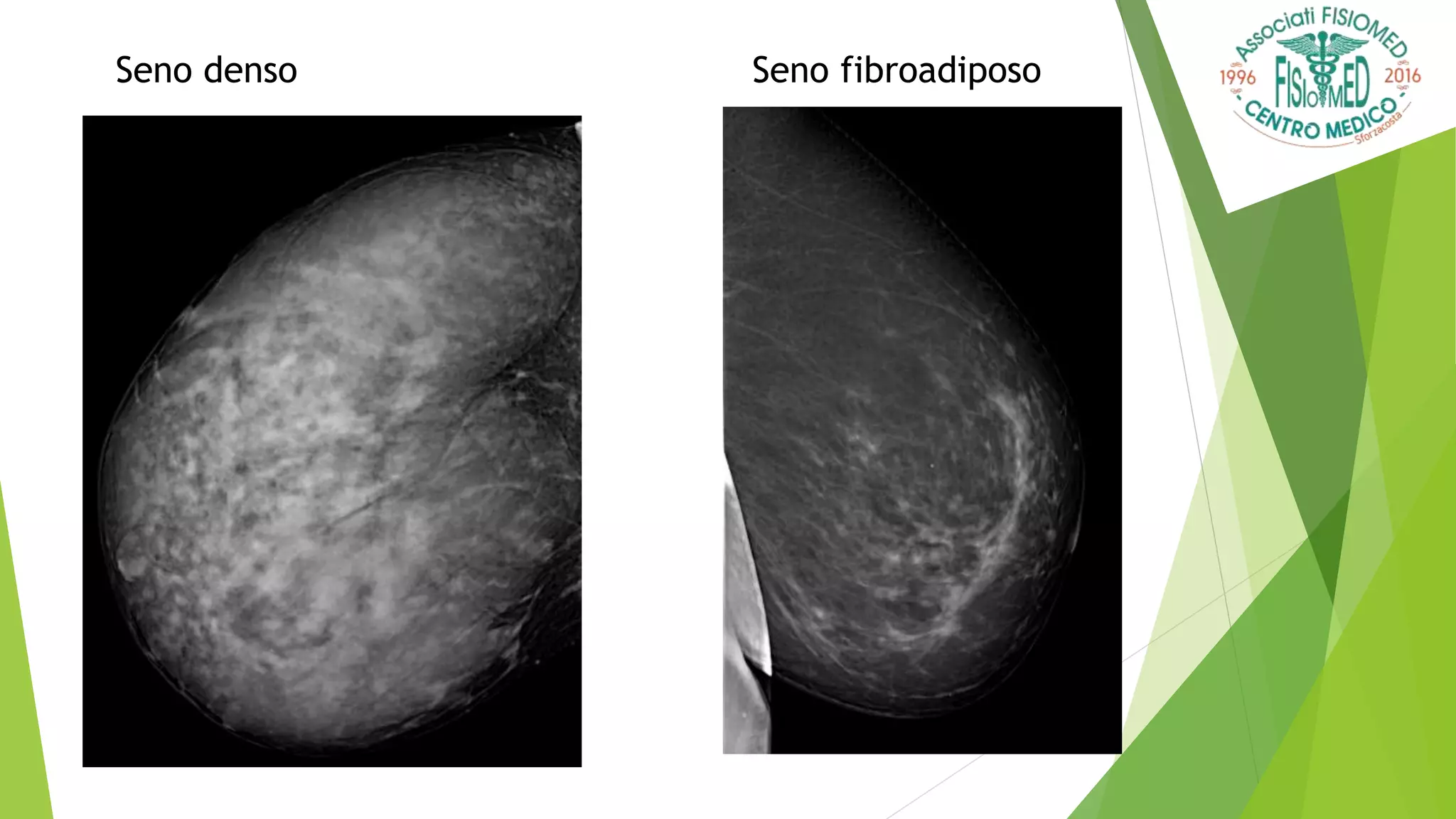 Mammografia 3d con tomosintesi | PPTX