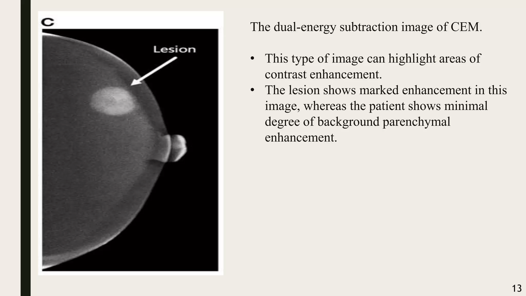 Mammogram and BI-RADS classification .pptx