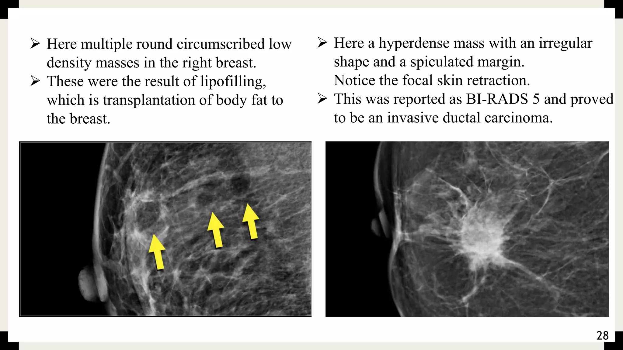 Mammogram and BI-RADS classification .pptx