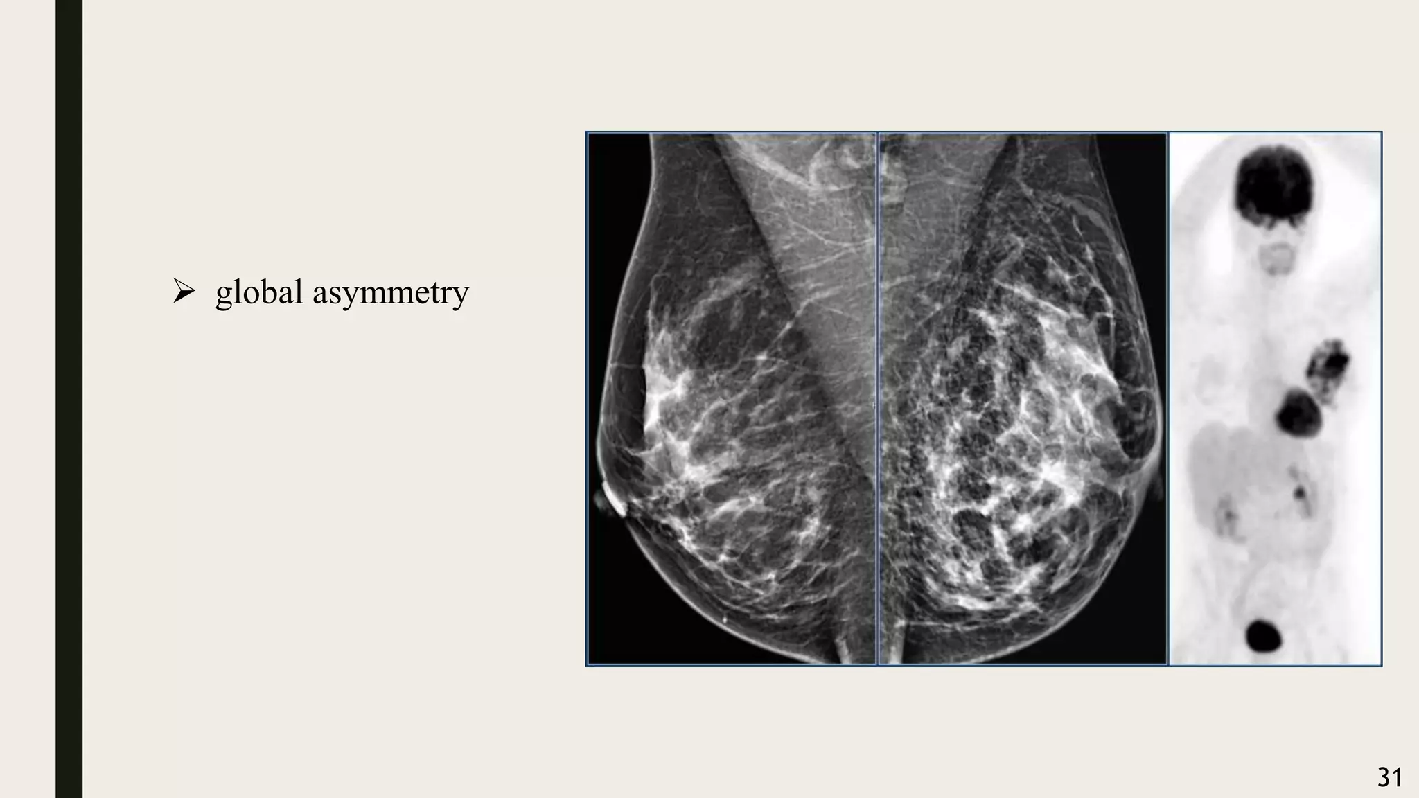 Mammogram and BI-RADS classification .pptx