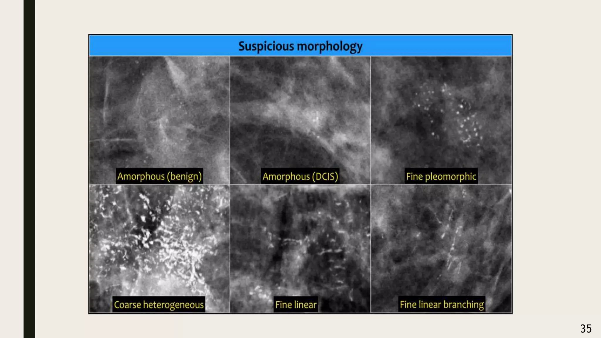 Mammogram and BI-RADS classification .pptx