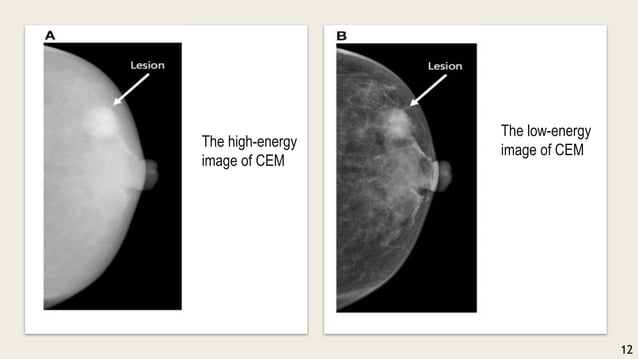 Mammogram and BI-RADS classification .pptx