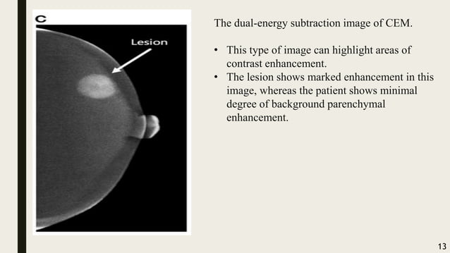 Mammogram and BI-RADS classification .pptx