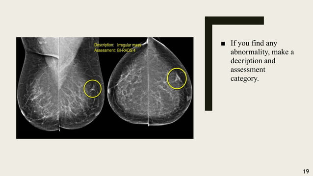 Mammogram and BI-RADS classification .pptx