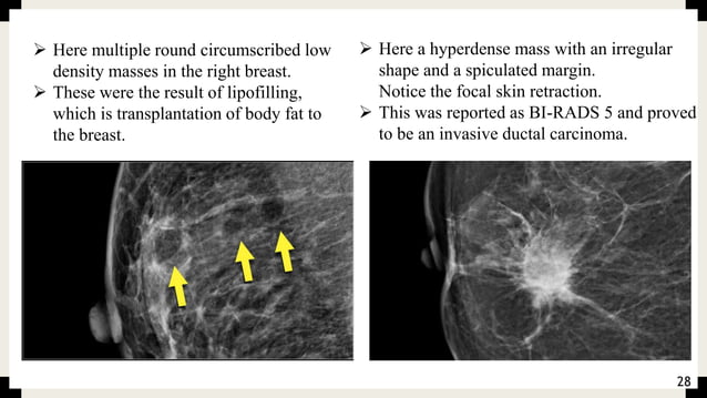 Mammogram and BI-RADS classification .pptx