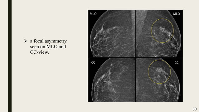 Mammogram and BI-RADS classification .pptx