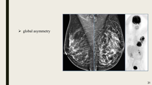 Mammogram and BI-RADS classification .pptx