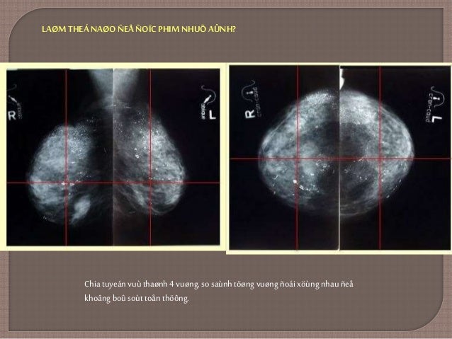 Mammogram update