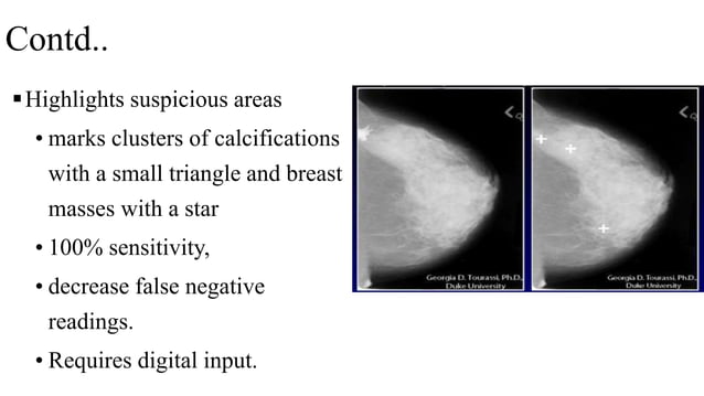 Mammographic equipment and its advancement | PPTX | Photography | Arts and Crafts