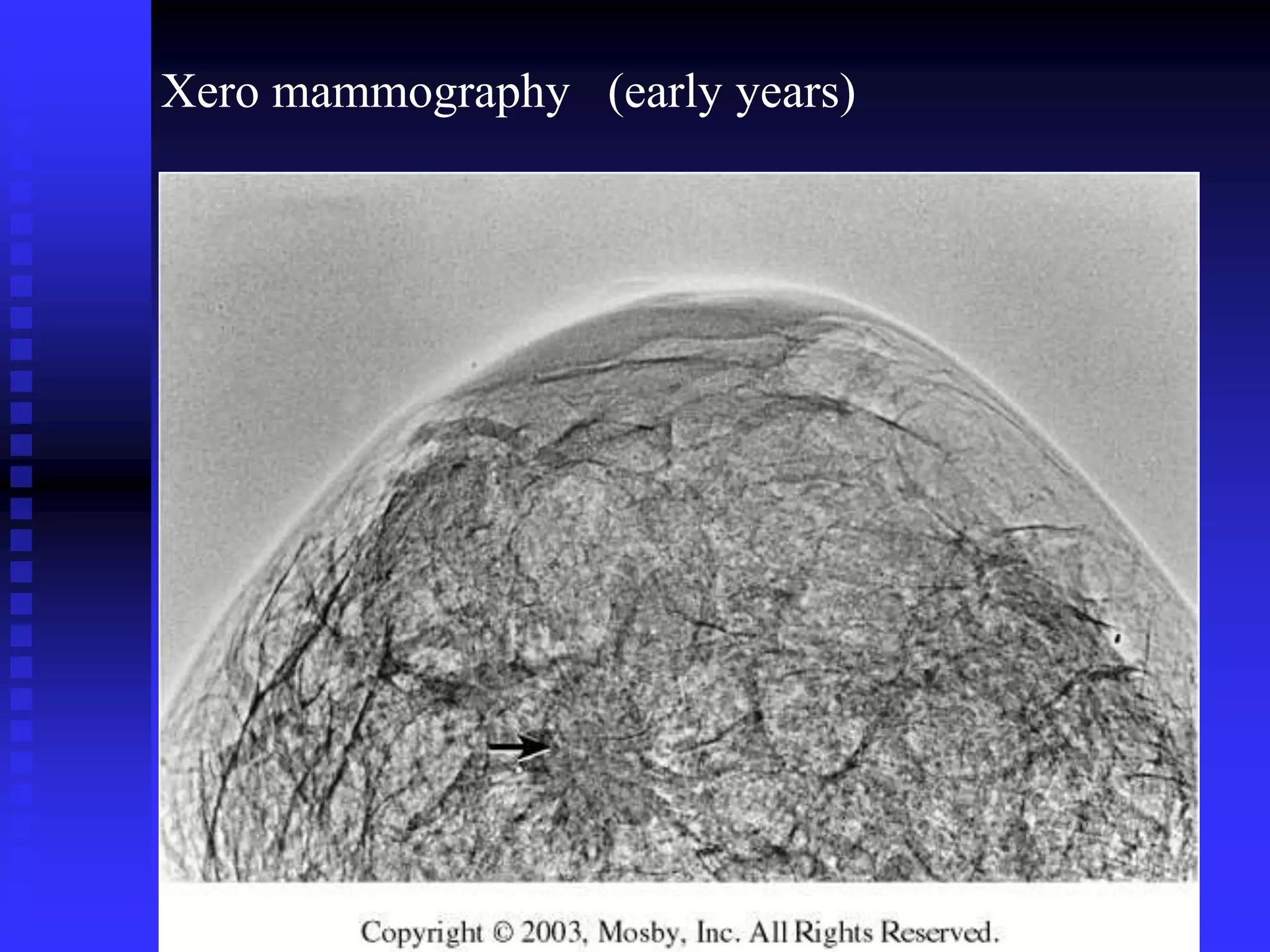 Mammography | PPTX