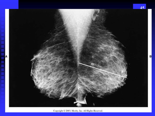 Mammography | PPTX | Cancer | Diseases and Conditions