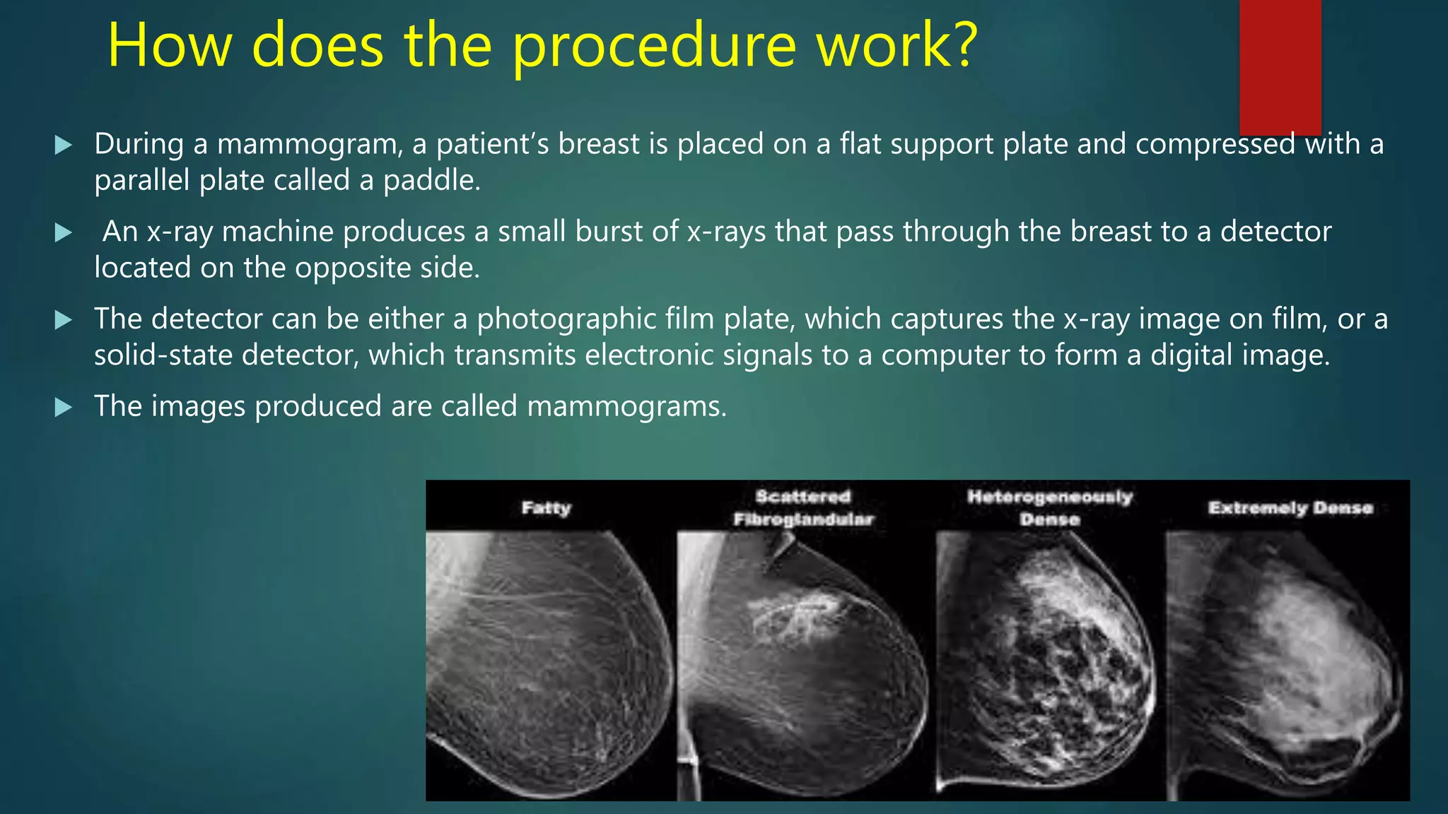 Mammography | PPTX